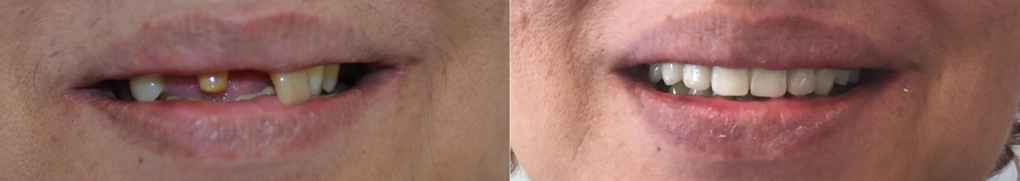 Εμφυτεύματα – All Ways Smile